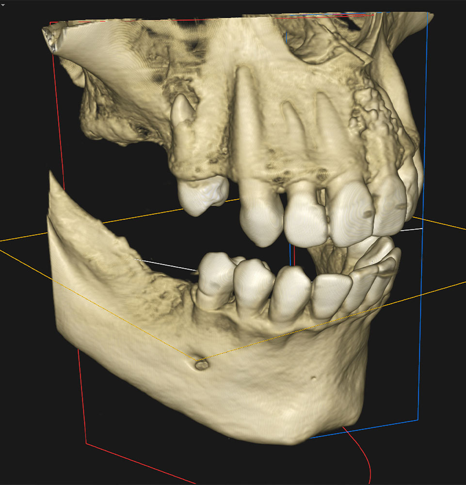 Bone Loss | Bone Grafting | Raleigh, NC