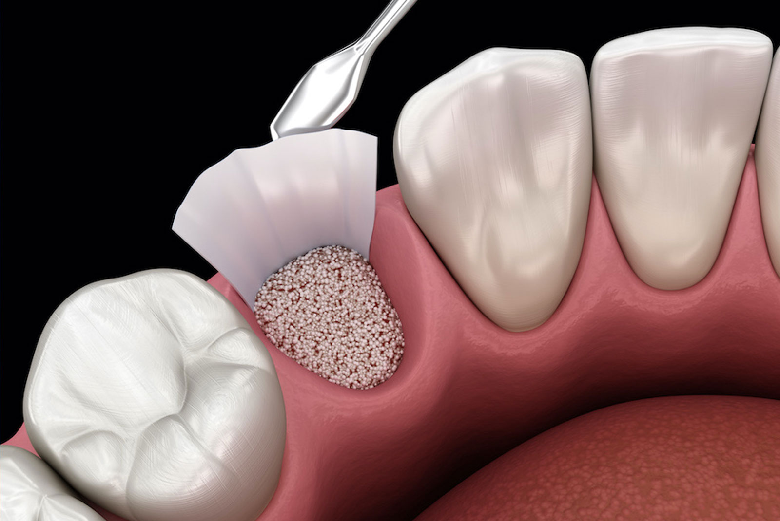 Dental Implants Raleigh NC - Highland Implant Center