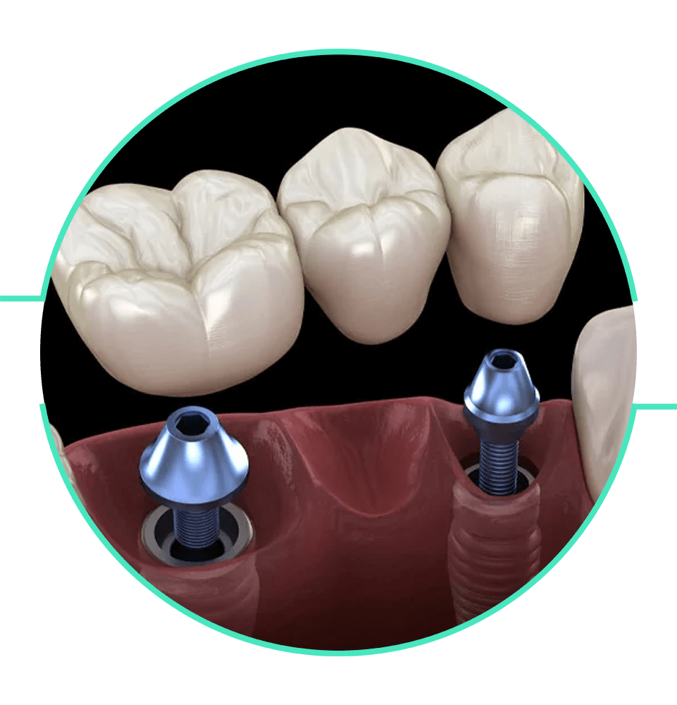 Replace Missing Teeth | Tooth Extractions | Raleigh, NC Replace Missing Teeth | Tooth Extractions | Raleigh, NC