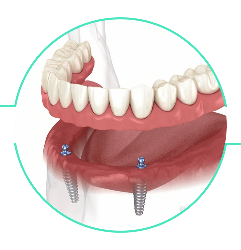 Replace Missing Teeth | Tooth Extractions | Raleigh, NC Replace Missing Teeth | Tooth Extractions | Raleigh, NC